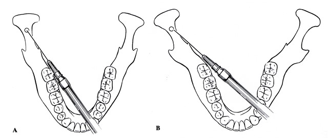 Hinman Connects Blog: Simplifying the Gow-Gates Mandibular Division ...